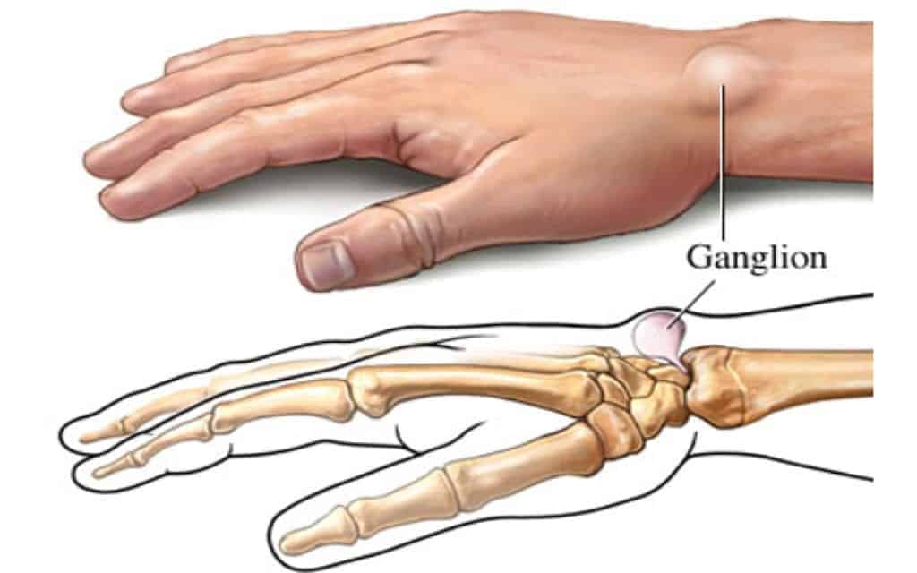 Ganglion Cyst – Mississauga Chiropractor and Physiotherapy Clinic ...