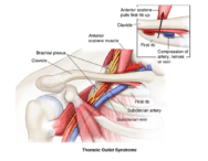 Thoracic Outlet Syndrome – Mississauga Chiropractor and Physiotherapy ...