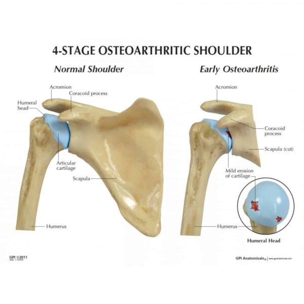 Shoulder Arthritis – Mississauga Chiropractor and Physiotherapy Clinic ...