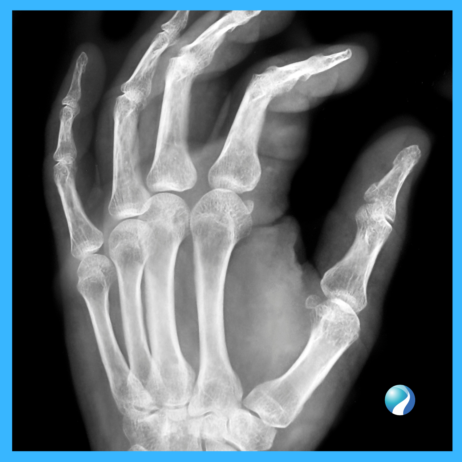 BPOP – Bizarre Parosteal Osteochondromatous Proliferation – Mississauga ...