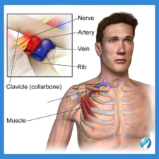Understanding Thoracic Outlet Syndrome (TOS) – Mississauga Chiropractor ...