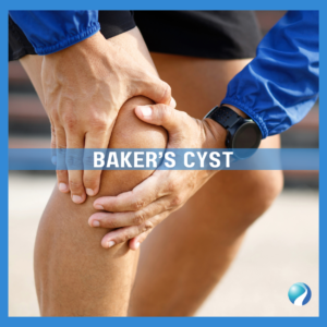 How To Manage A Baker's Cyst - Mississauga Chiropractor and ...