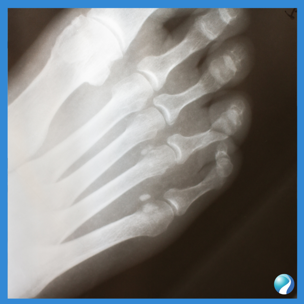 Proximal Phalanx Fracture of the Foot: Comprehensive Guide for Patients ...